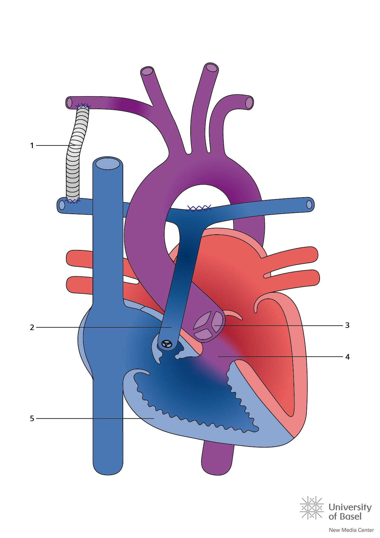 Blalock Taussig Shunt Tetralogy Fallot